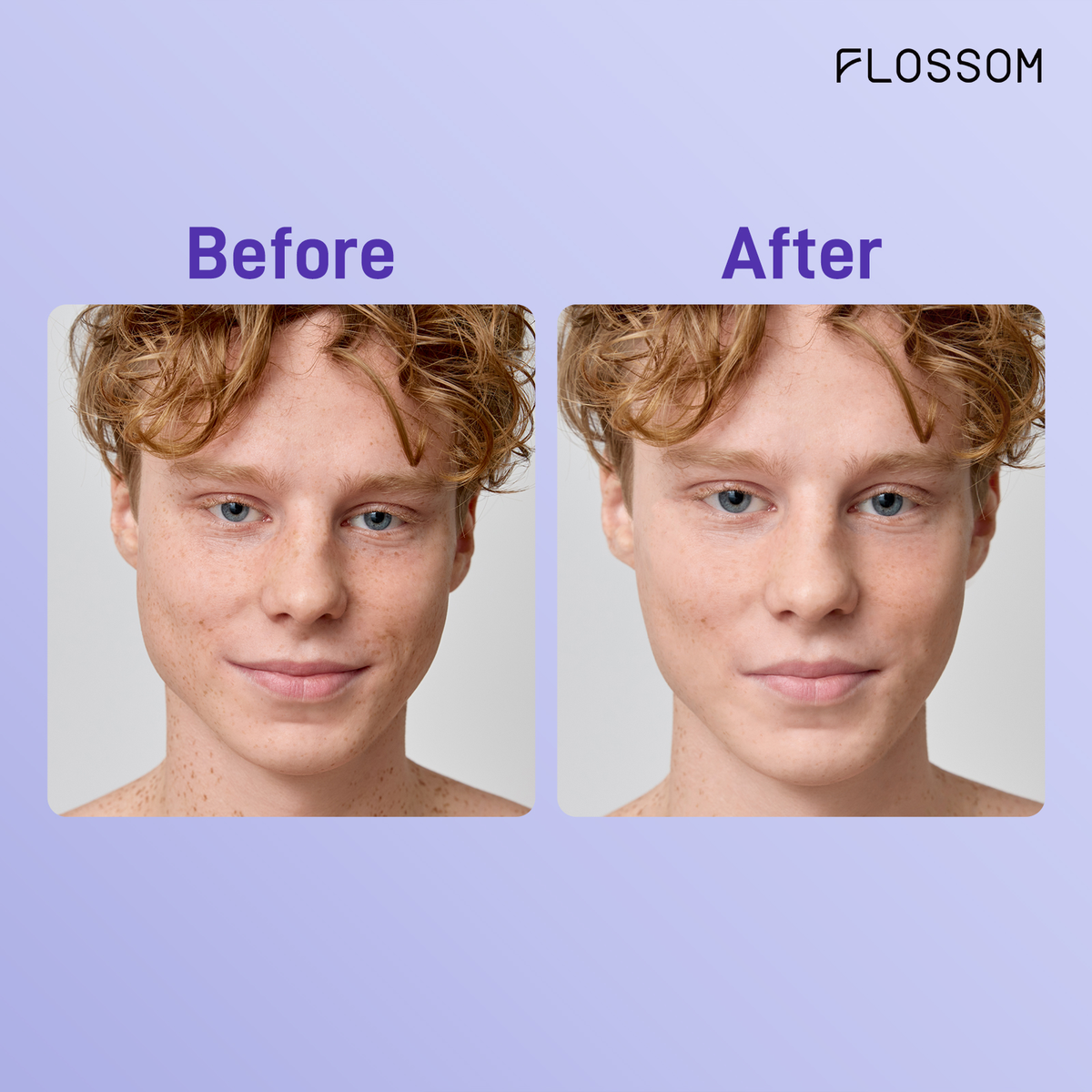 FLOSSOM LED Mask WL100 – Flossom Beauty Store